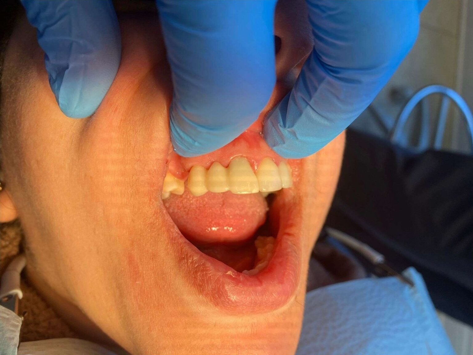 Symptoms of Ill-Fitting Dental Bridge