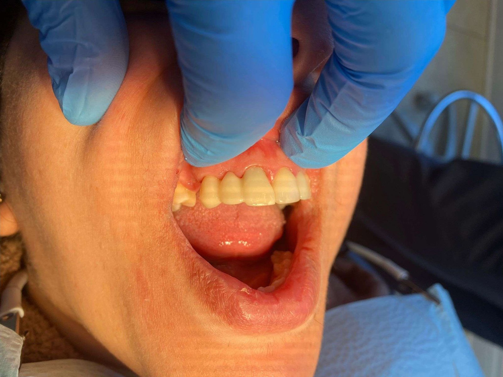 Symptoms of Ill-Fitting Dental Bridge